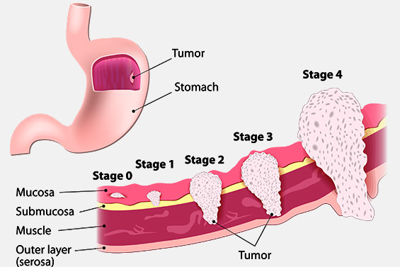 Oesophageal & Gastric Cancer - Total Upper GI Surgery