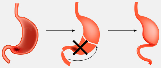 Oesophago-gastric Cancer Surgery - Total Upper GI Surgery