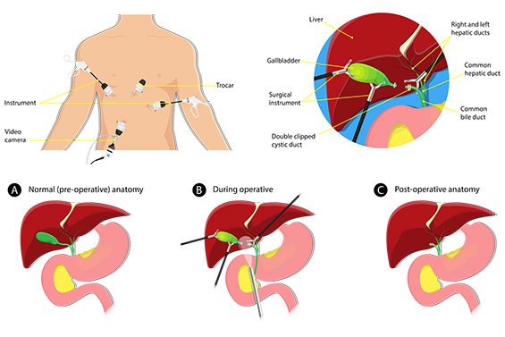 General Surgery - Total Upper GI Surgery
