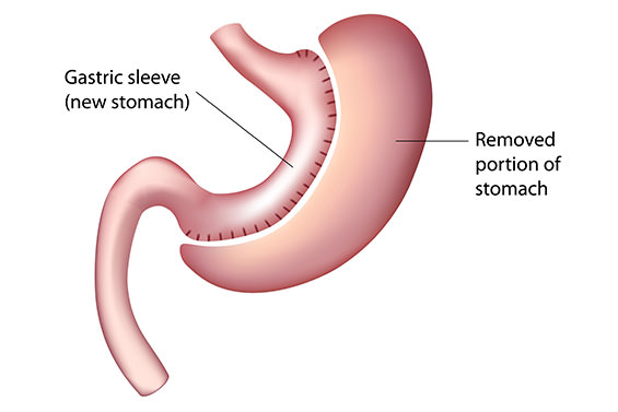 Weight Loss Surgery - Total Upper GI Surgery